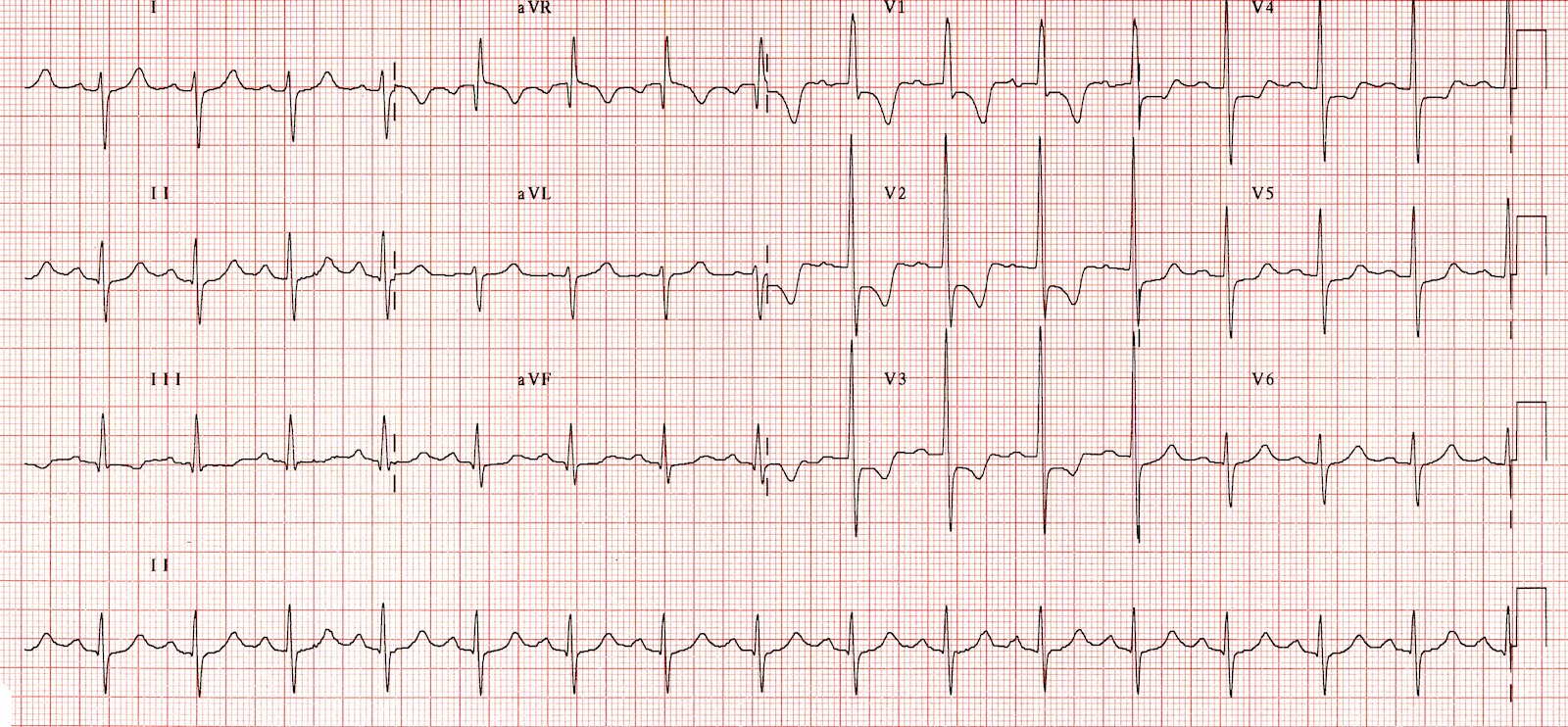 Ecg Interpretation Questions In The Cicm Fellowship Exam Deranged